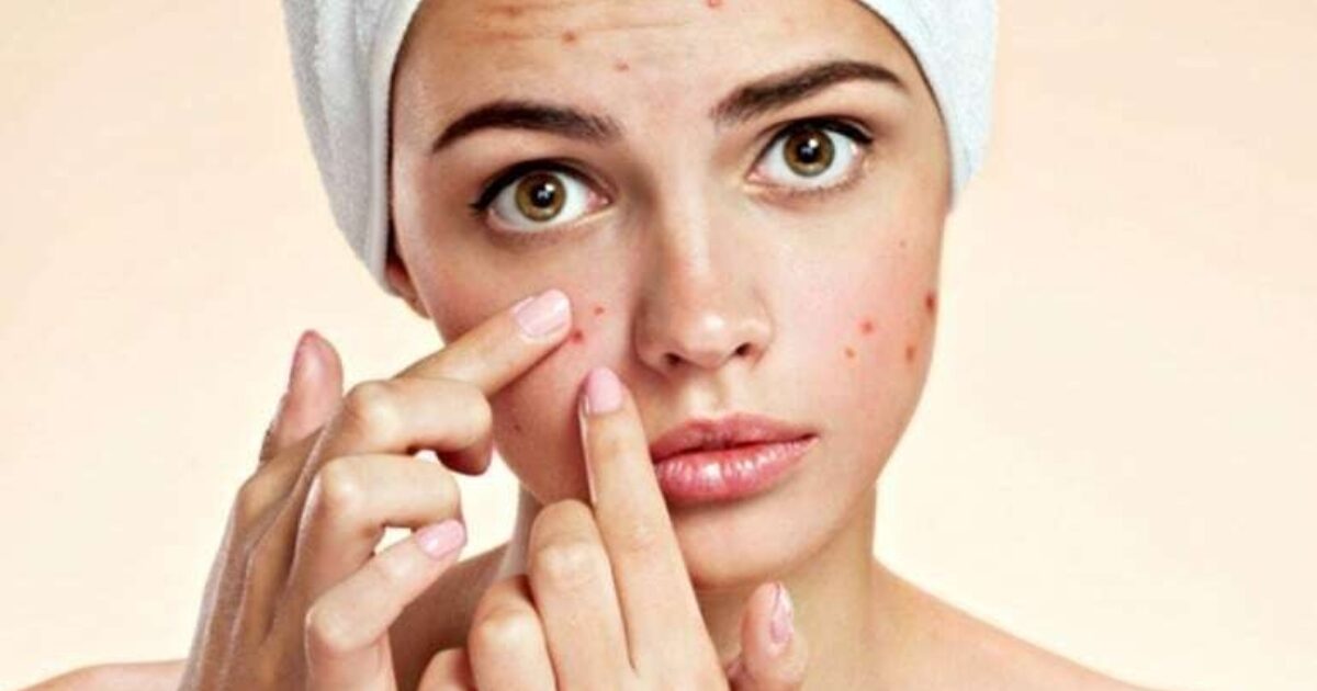 Akné - liečba, príznaky, domáce recepty | Zdravopedia.sk