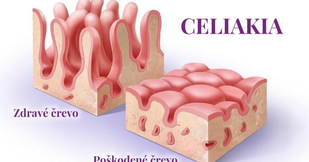 Celiakia - liečba, príznaky, domáce recepty | Zdravopedia.sk