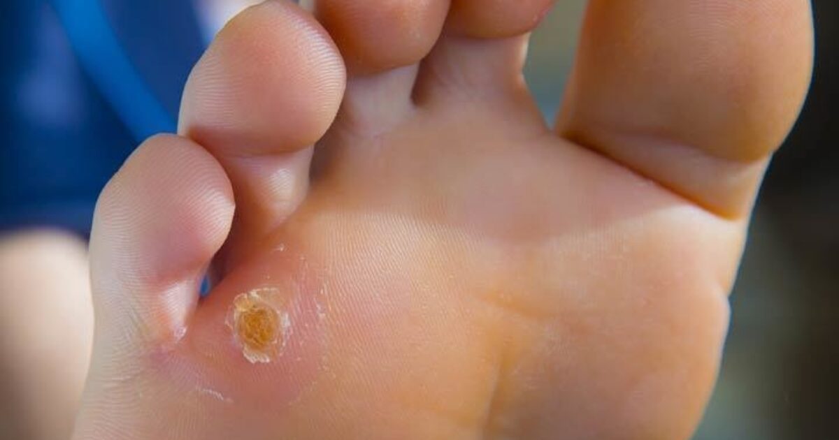 Kuří oko - léčba, příznaky, domácí recepty | Zdravopedie.cz