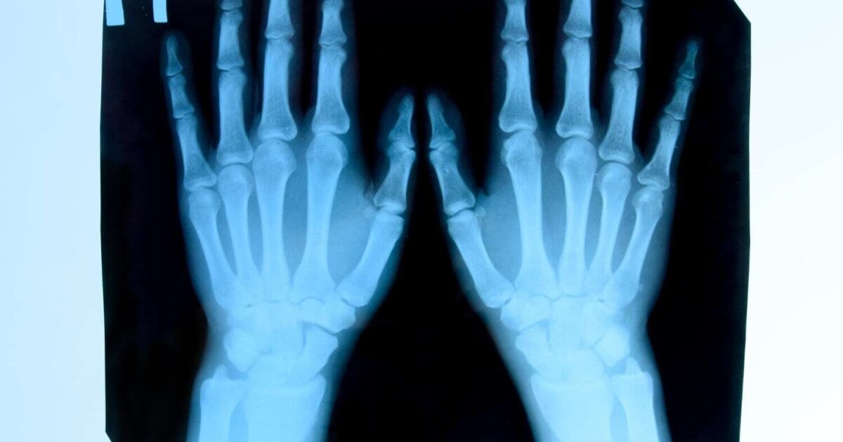 Rentgen - jak funguje, kdy se provádí, jak probíhá vyšetření a případná ...